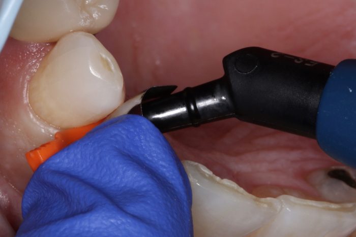 Case Report: Anterior Matrix Systems Essential to Provide Proper ...