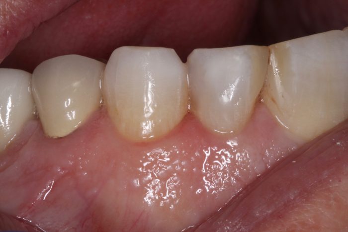 Case Report: Anterior Matrix Systems Essential to Provide Proper ...