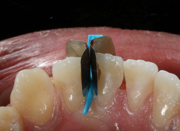 The New Fusion Anterior Matrix System: A Modern Approach to Anterior ...