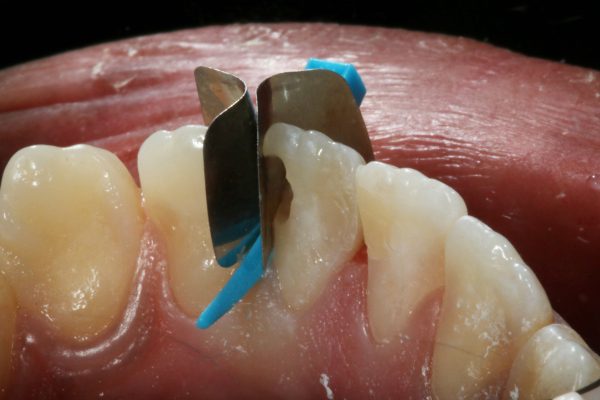 The New Fusion Anterior Matrix System: A Modern Approach to Anterior ...