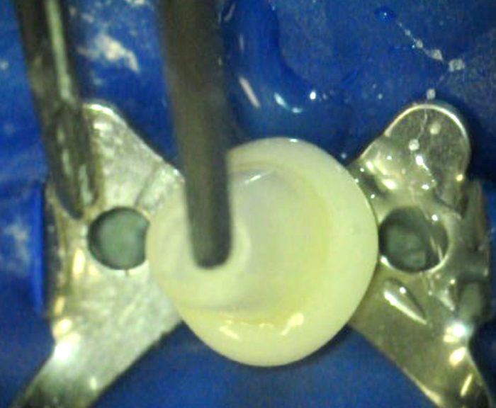 Factors for Successful Endodontic Post Placement: A Step-By-Step Guide ...