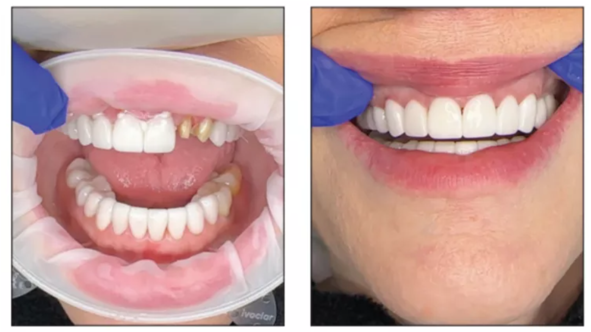 Understanding Bonding Agents for Success in Dentistry - Group Dentistry Now